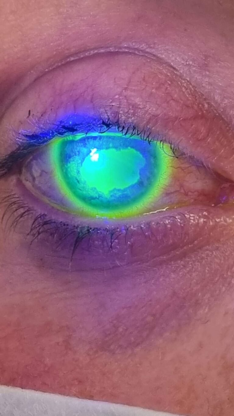 What is RCE - RECURRENT CORNEAL EROSION
